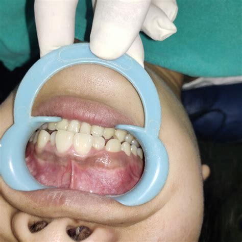 Swelling Present Over The Left Maxillary Sinus In The Nasofacial Region Download Scientific