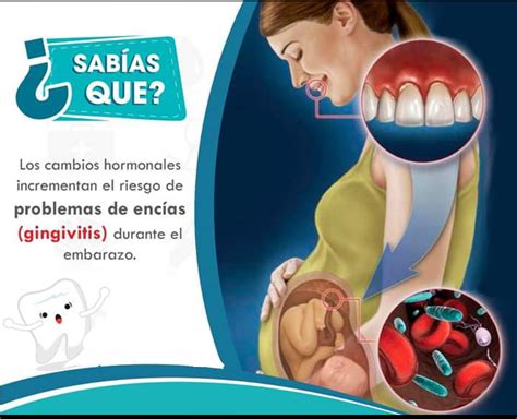 La Gingivitis Del Embarazo Está Clinica Dental Aparcana Facebook
