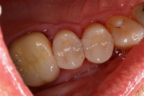 Class Ii Composites Sub Gingival Margin Large Embrasure And Cusp