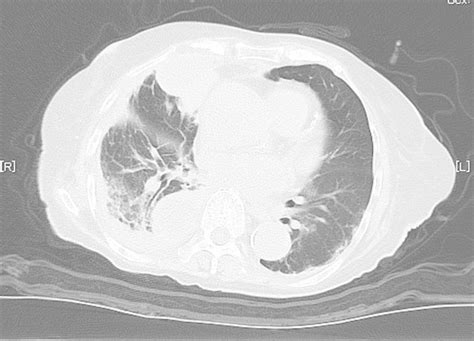 Chest Ct Scan Images Upon Admission Reveal The Presence Of A Pyothorax Download Scientific