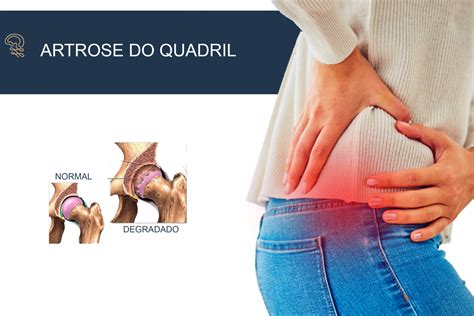 Artrose Do Quadril Dr Guilherme Rossoni