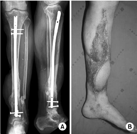 The Type IIIB Open Fracture Of Tibia Was Healed Without Infection And Download Scientific