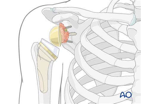 Revision Of An Anatomic All Polyethylene Glenoid Component For Glenoid Implant Loose Poor Bone