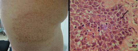 Mycosis Fungoides Need Immunohistochemistry Download Scientific Diagram