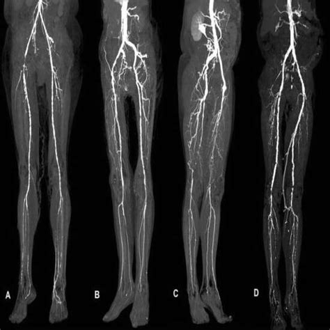 CT Peripheral Angiography Test Price In Delhi Ganesh Diagnostic
