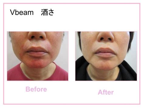 【顔の赤みが気になる方】毛細血管拡張症〈vbeeamⅡ〉※保険適応あり あつた皮ふ科クリニック・美容皮膚科クリニック