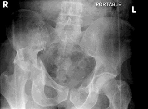 Pelvic Bone Fracture