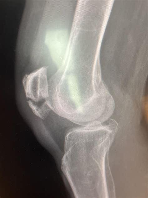 Patellar Fracture R Xrayporn