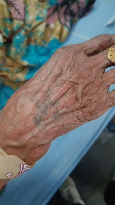 Old Age Female Cannulation Technique How To Cannulation Old Age 85 Age