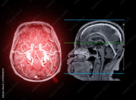 Mri Brain Scan Sagittal Plane For Detect Brain Diseases Sush As Stroke