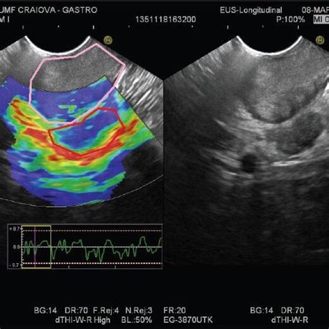 A Patient With A Malignant Lymph Node Next To A Primary Tumor The Download Scientific Diagram