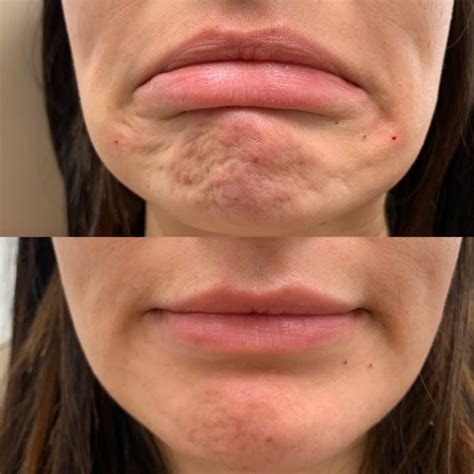 Before And After Botox Beauty Boost In Newport Beach Ca