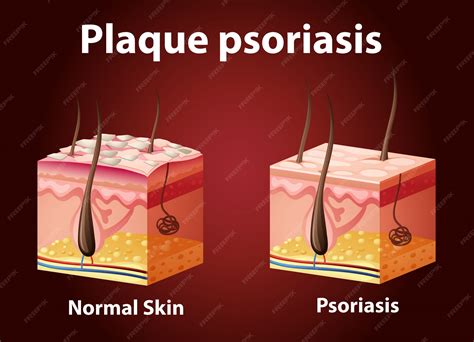 Diagrama Que Muestra La Psoriasis En Placas Vector Premium