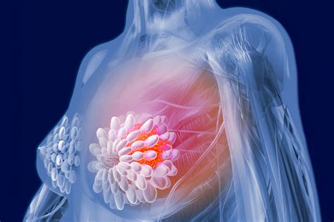 Fda Approval Prompts Updates To Asco Breast Cancer Guidelines
