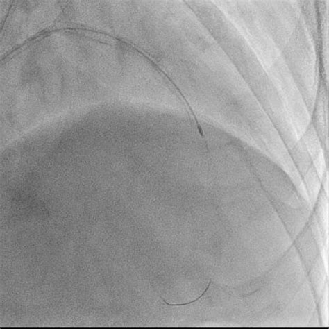 Rotational Atherectomy With 1 25mm Burr To Mid Lad Download
