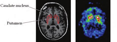 Co Registered Mr A Showing Striatal Structures And Neurotransmission