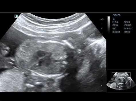 Echogenic Ultrasound