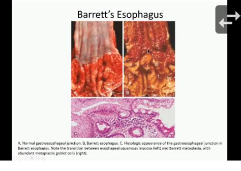 Tubular Gi Cancers Flashcards Quizlet