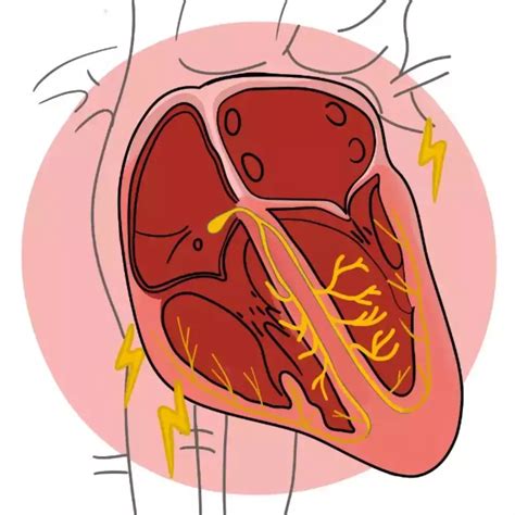 AkutnĚ Cz Syndrom Dlouhého Qt Intervalu