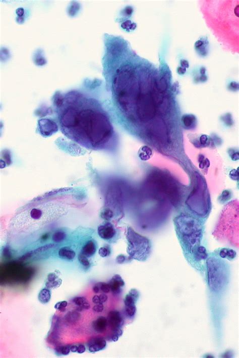 Herpes Labial Y Genital Concise Medical Knowledge