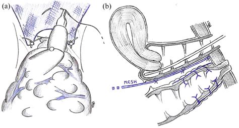 The Mesh Is Sutured Distally To The Posterior Vaginal Wall To Lift The Download Scientific
