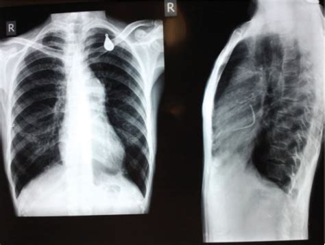 Estenose Pulmonar Concise Medical Knowledge