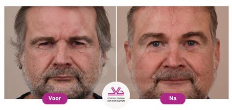 Ooglidcorrectie Voor En Na Fotos Bekijk Hier Resultaten