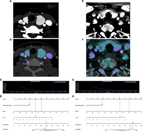 Examples Of Application Of Nomogram To Predict Probability Of Benign