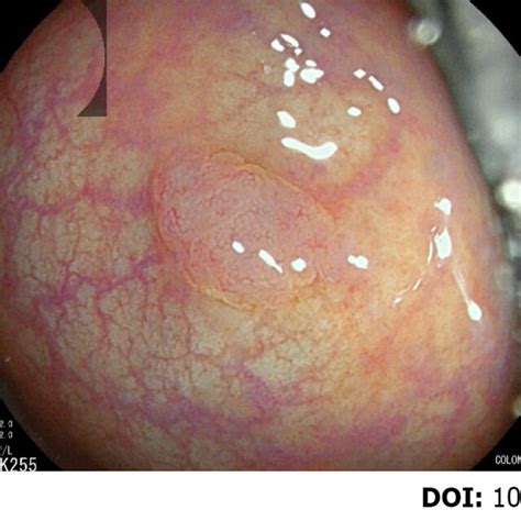 Sessile Serrated Adenoma Seen On White Light Imaging And Texture And