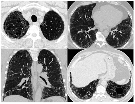 Hrct Patterns In Cpfe A Predominant Pattern Of Centrilobular Emphysema Download Scientific