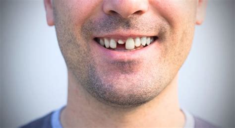 Fractured Tooth Dentouch