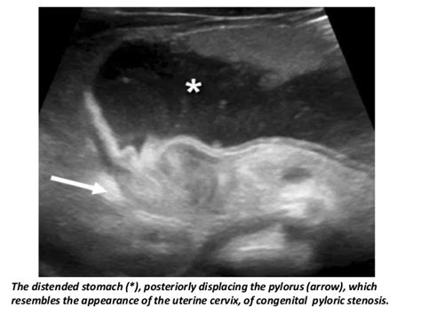 Double Track Sign In Pyloric Stenosis Not Pathognomonic For