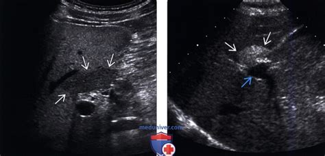 Лучевая диагностика стеатоза печени