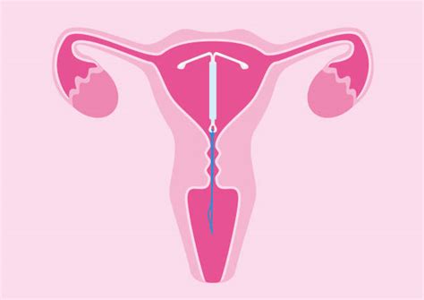 280 Hormonal Intrauterine Device Stock Illustrations Royalty Free