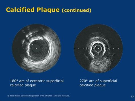 Ivus Image Interpretation And Analysis