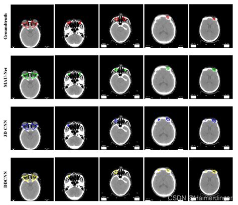 近两年值得阅读的十篇医疗图像分割文献multi Organ Segmentation Over Partially Labeled Da