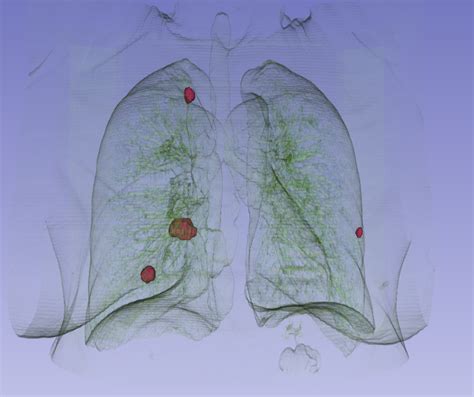 Artificial Intelligence Helps To Screen Lung Cancer More Effectively Semmelweis University