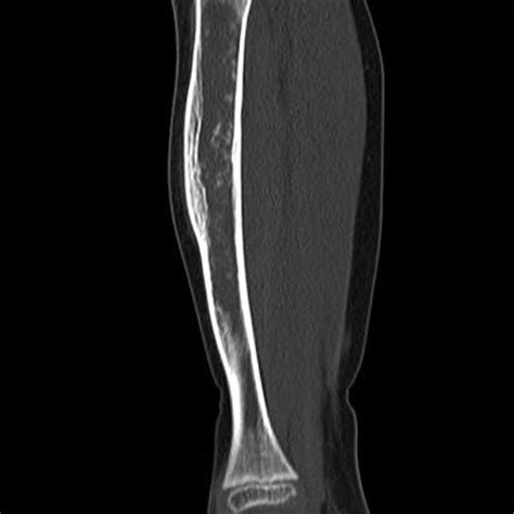 Mast Cell Sarcoma Of The Tibia Journal Of Clinical Pathology