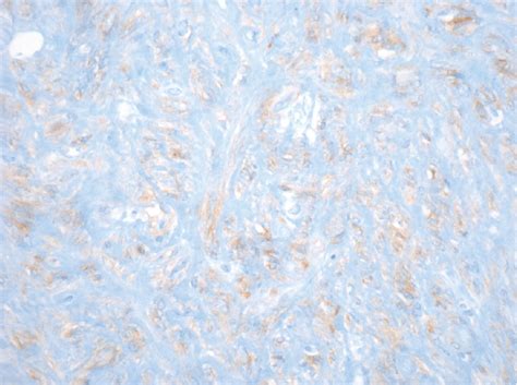 Spindle Cell Gist Showing Diffuse Immunopositivity For Cd117 Kit Download Scientific Diagram
