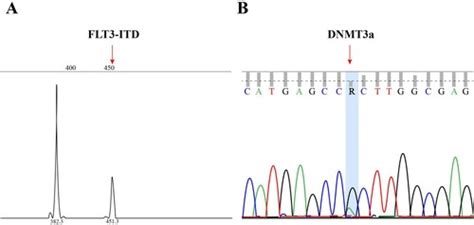 full article sweet syndrome induced by flt3 inhibitors case report