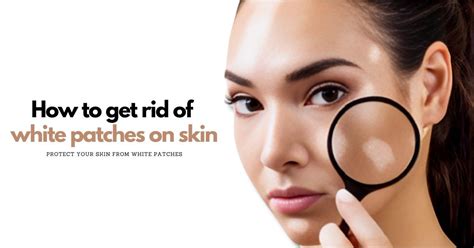 How To Cure White Patches On The Skin