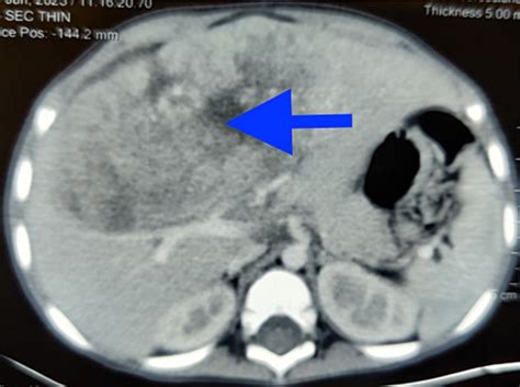 Radiological Features Of A Well Defined Heterogeneously Enhancing