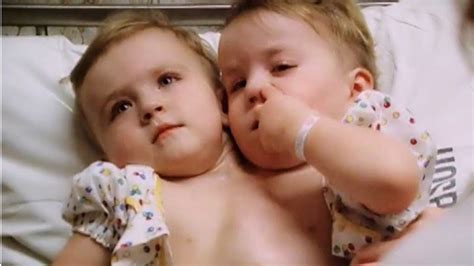 Katie And Eilish Siamese Twins 1992 Mubi