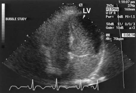 Intrapulmonary Arteriovenous Shunt Diagnosis By Saline Contrast
