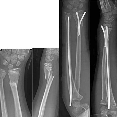 Pre And Postoperative X Rays Of Displaced Distal Forearm Fracture