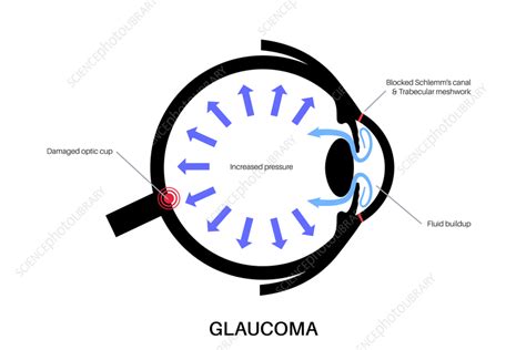 Glaucoma Illustration Stock Image F043 7260 Science Photo Library