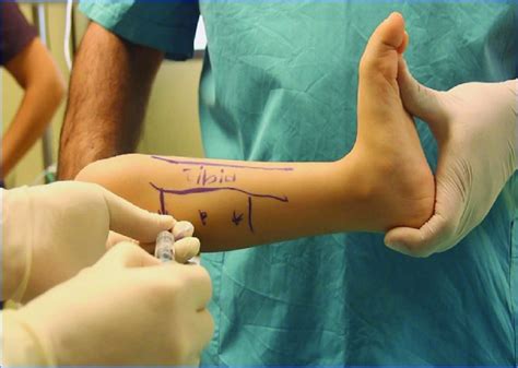 Application Technique Of Botulinum Toxin A Bont A Injection To The