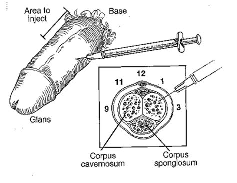 How To Inject Trimix Olympia Pharmaceuticals