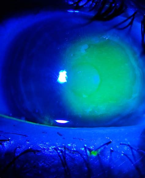 Dr Salman Nasir On Linkedin Corneal Ulcer Stained With Fluorescein