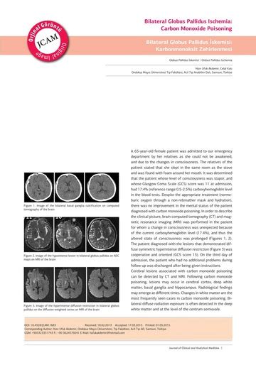 Bilateral Globus Pallidus Ischemia Carbon Monoxide Poisoning Hızır Ufuk Akdemir Celal Katı